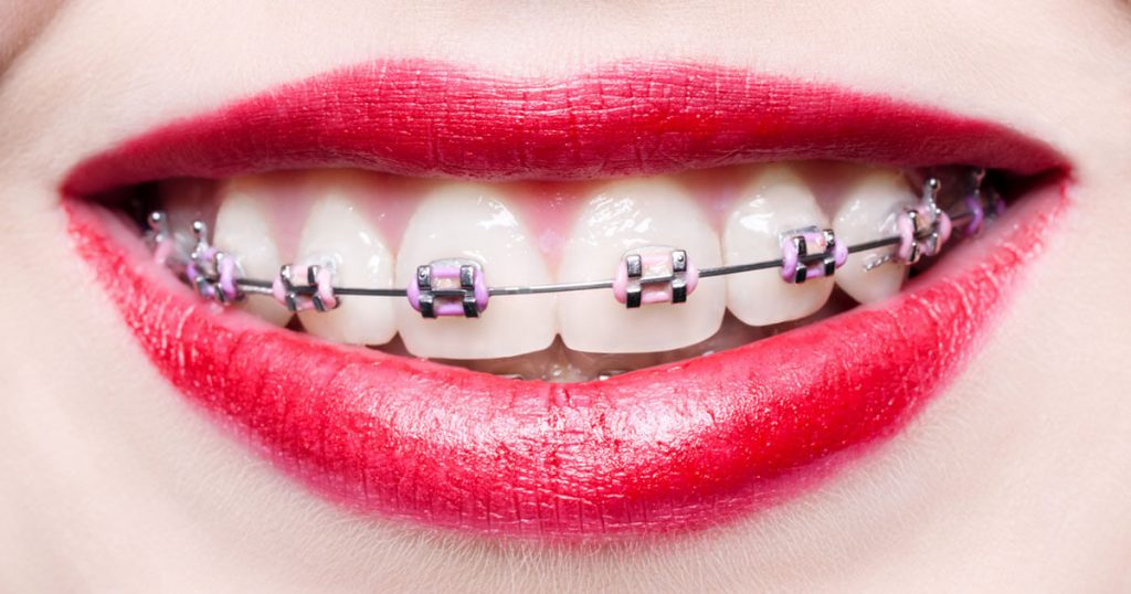 Brackets Metálicos - Clínica Dental Amparo Castañer